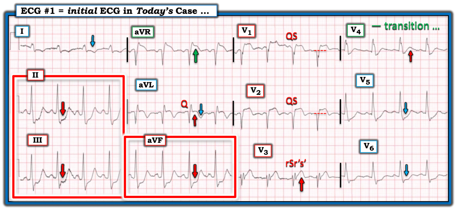 What is this pattern? - Dr. Smith’s ECG Blog