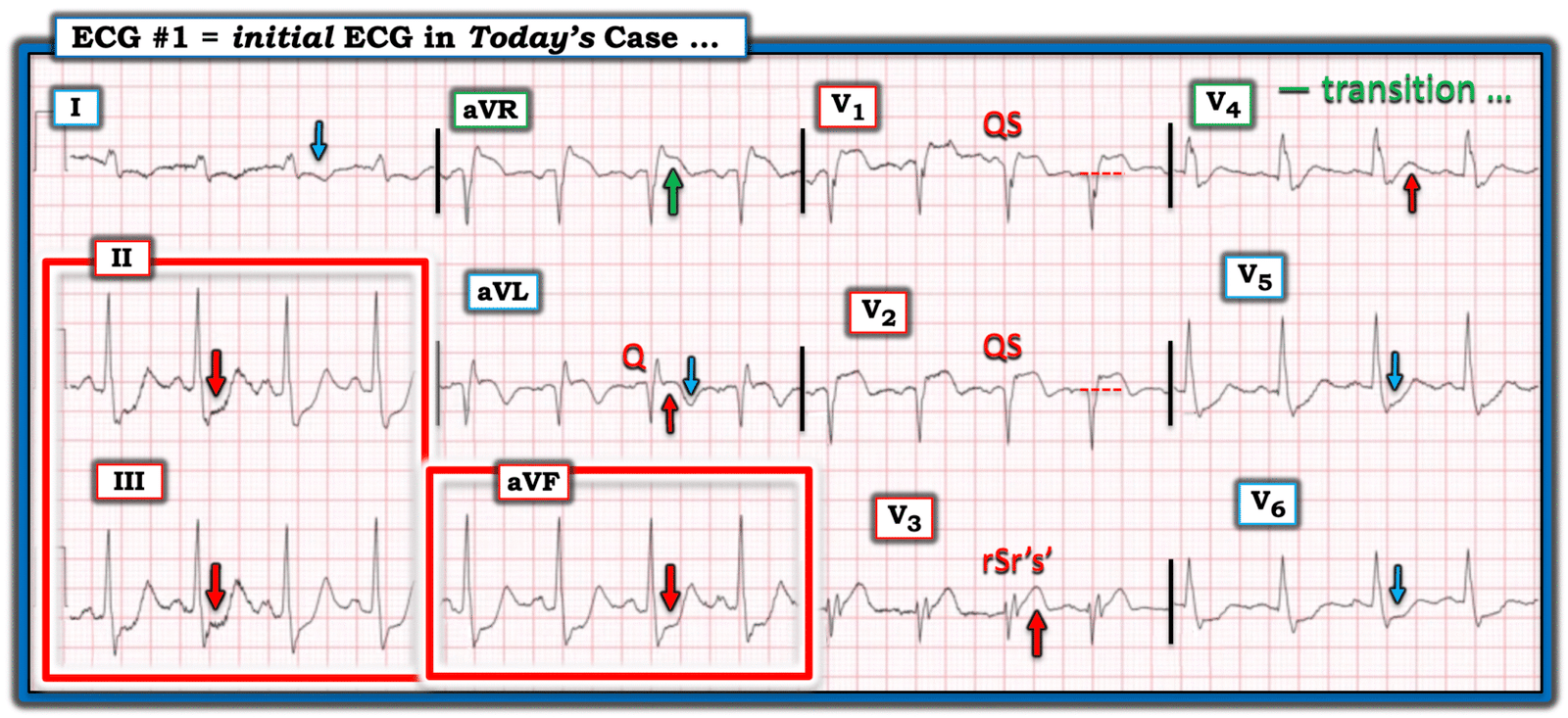 What is this pattern? - Dr. Smith’s ECG Blog