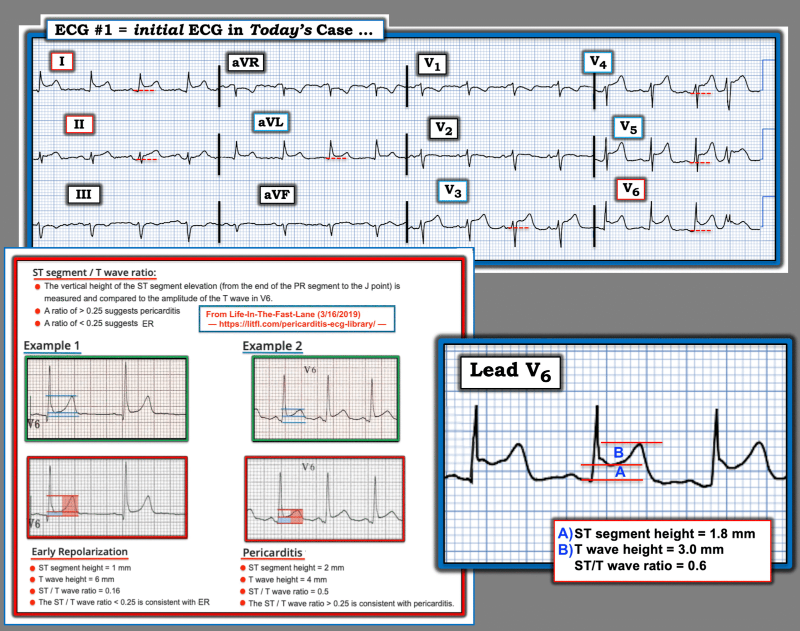 STEMI positive by conventional algorithm in a high risk post operative ...