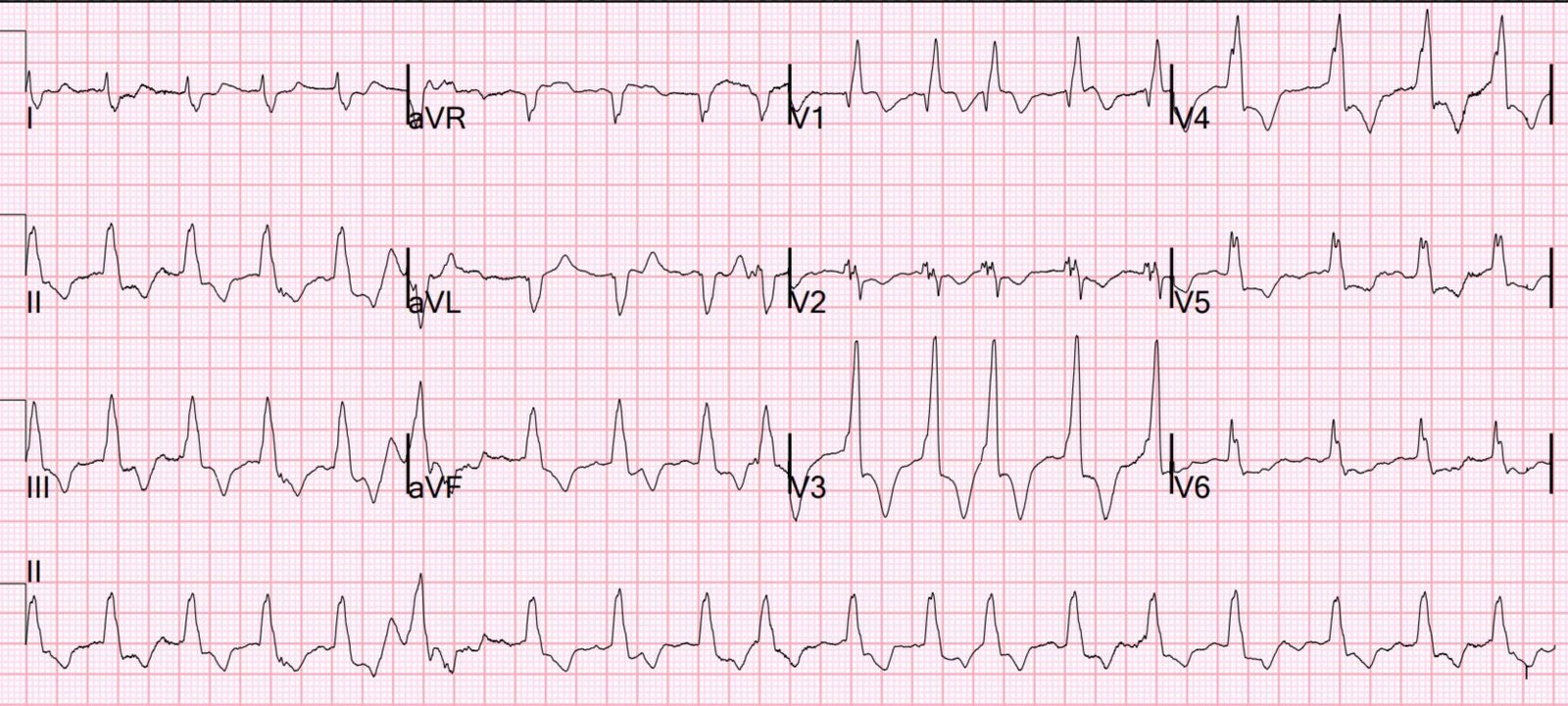 COPD exacerbation, followed by cardiac arrest. - Dr. Smith’s ECG Blog