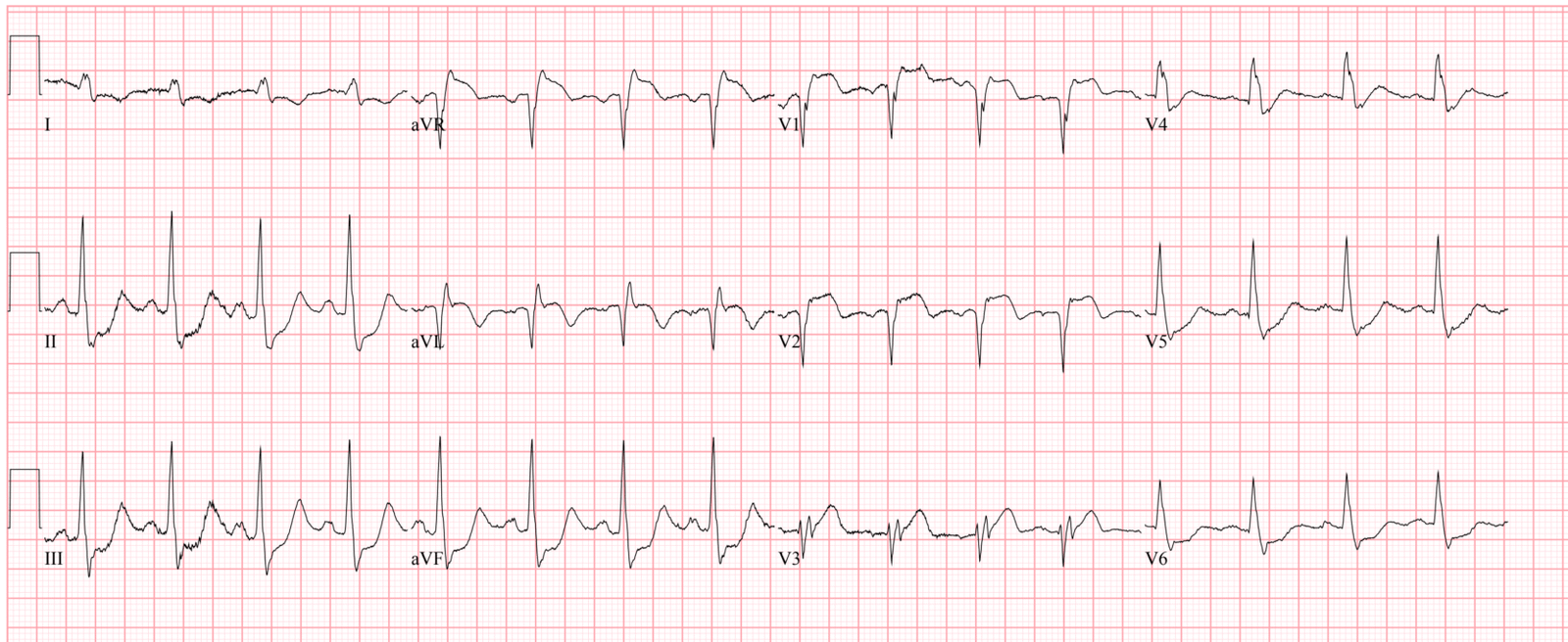 What is this pattern? - Dr. Smith’s ECG Blog