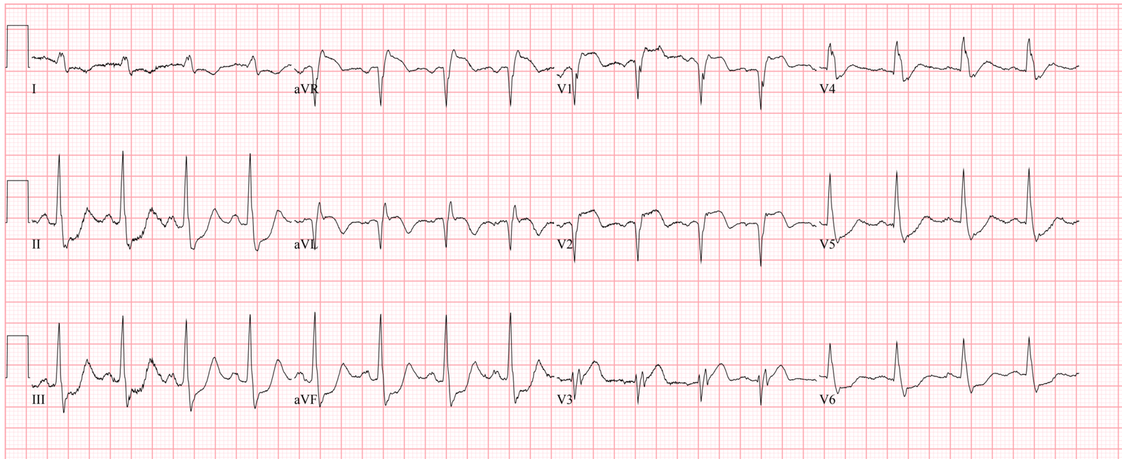 What is this pattern? - Dr. Smith’s ECG Blog