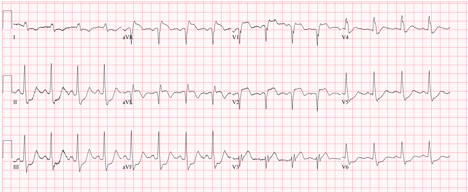 What is this pattern? - Dr. Smith’s ECG Blog