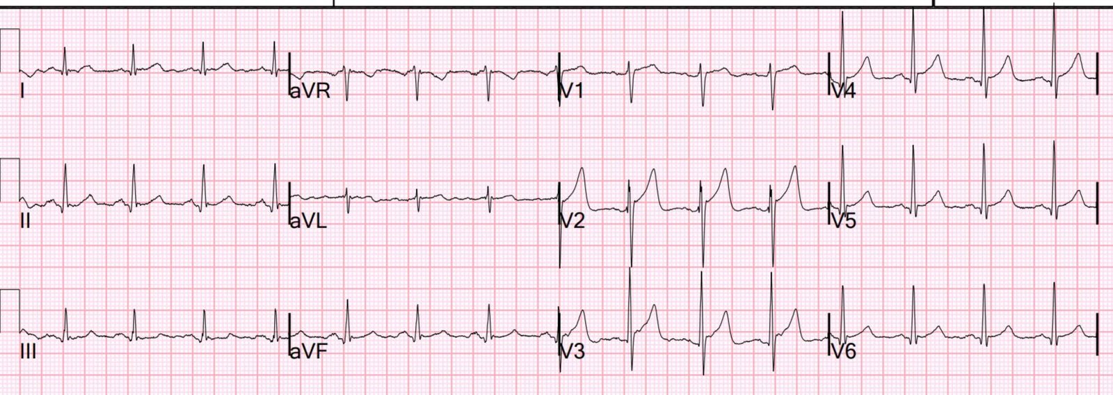 Acute chest pain in a 50-something: resolves, recurs, resolves: Does ...