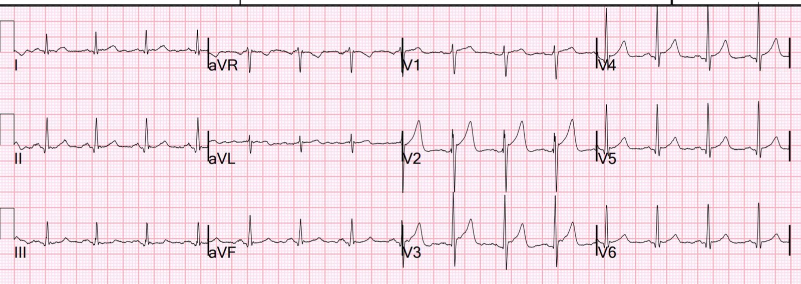 Acute chest pain in a 50-something: resolves, recurs, resolves: Does ...