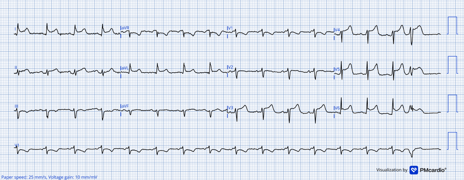 STEMI positive by conventional algorithm in a high risk post operative ...
