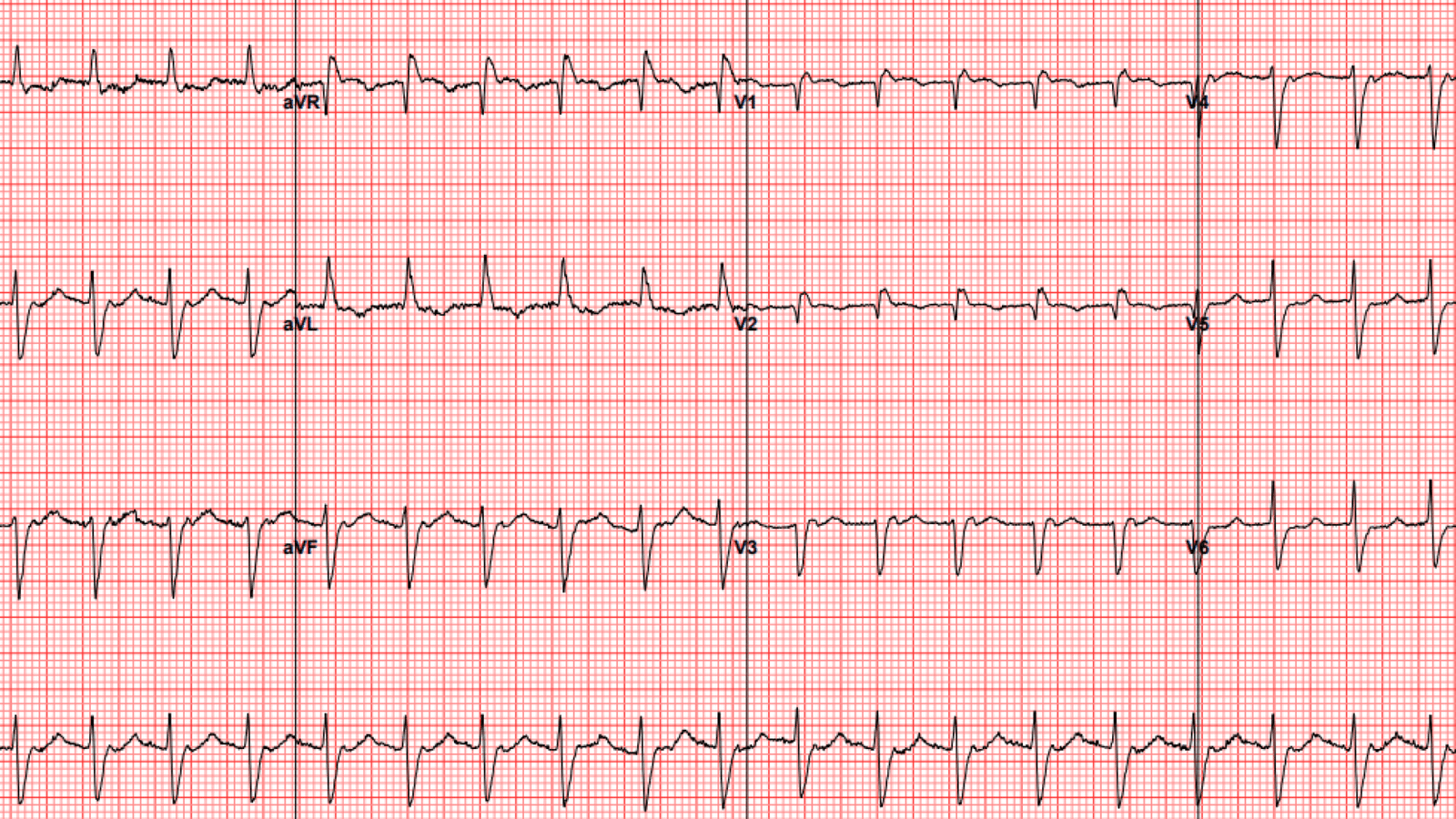ST-Elevation in aVR with diffuse ST-Depression: An ECG pattern that you must know and understand ...