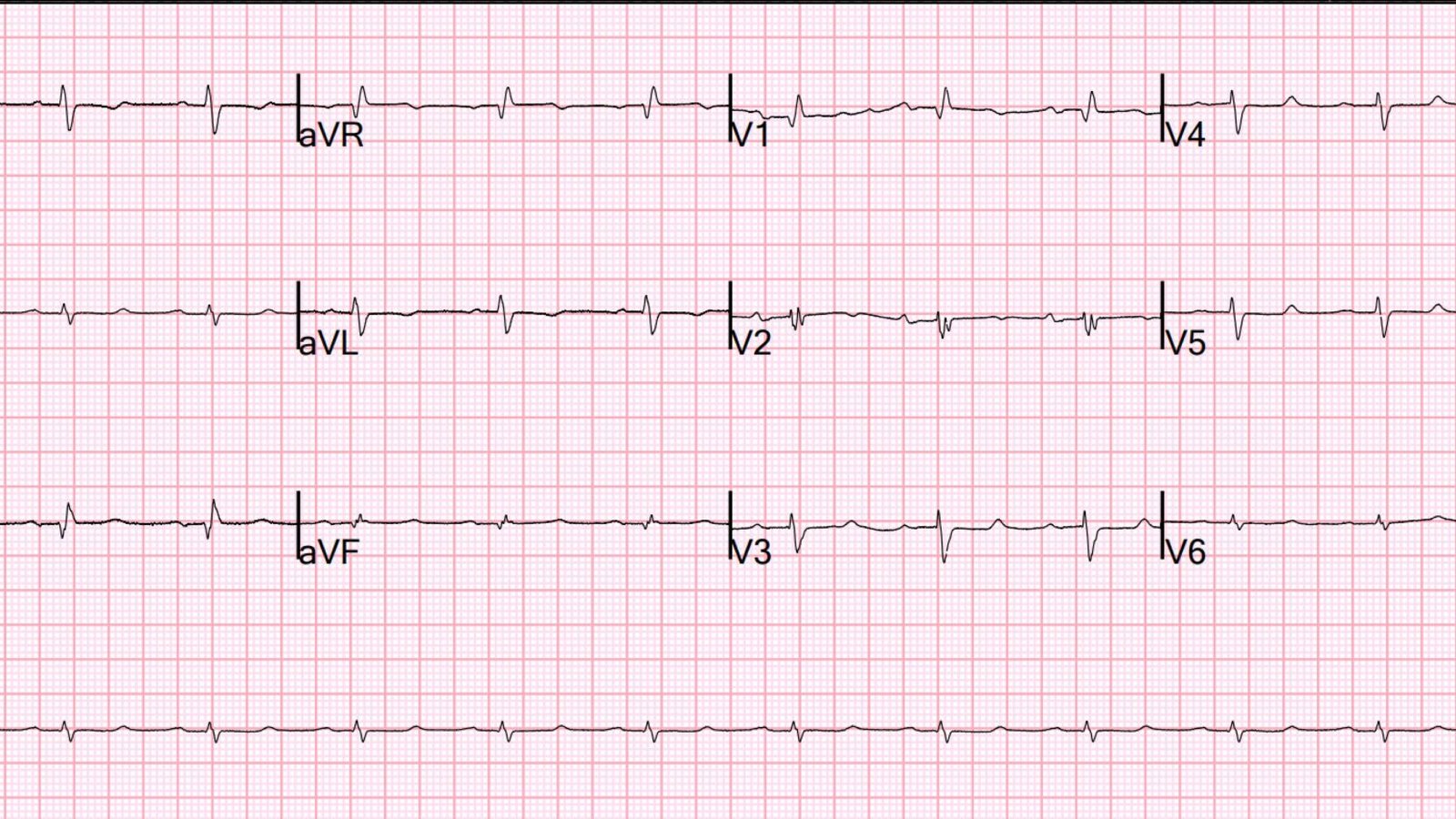 Steve Smith, Author at Dr. Smith’s ECG Blog