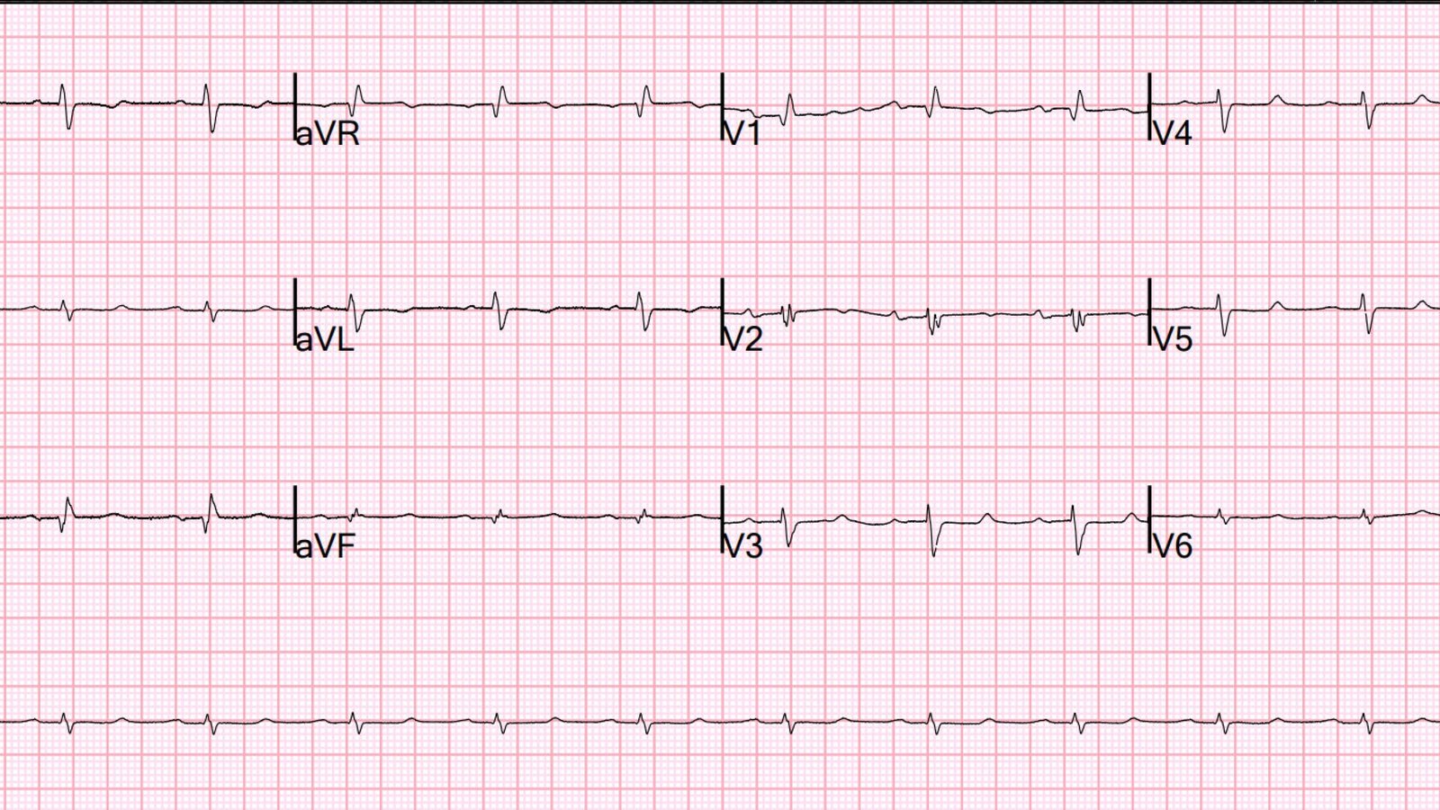 What is this pattern? - Dr. Smith’s ECG Blog