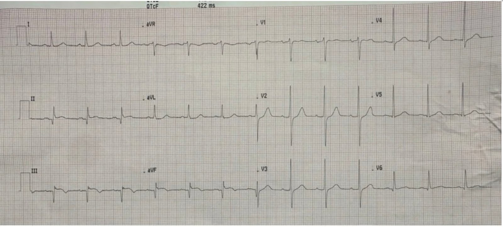 Chest pain, resolved. Reperfusion T-waves. Should the patient go ...