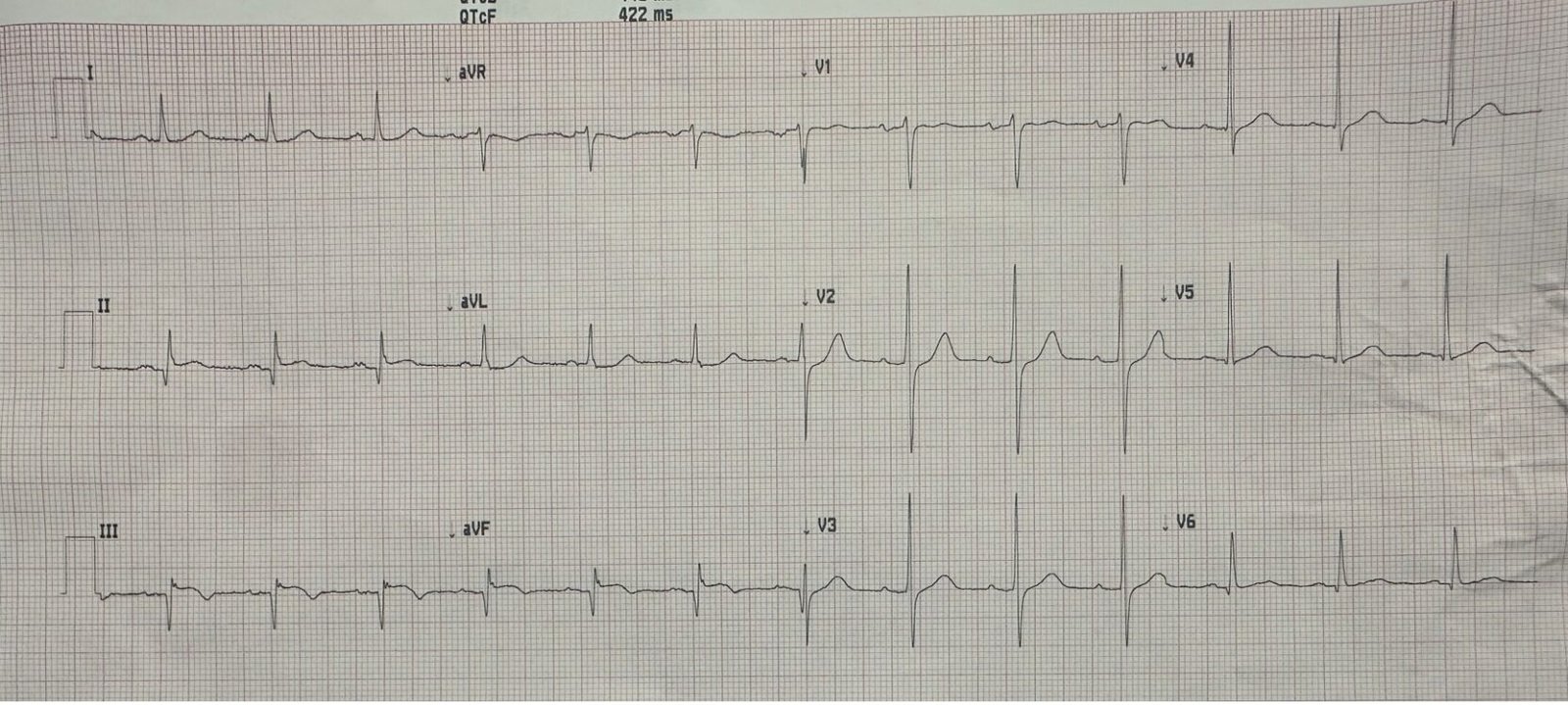 Chest pain, resolved. Reperfusion T-waves. Should the patient go ...