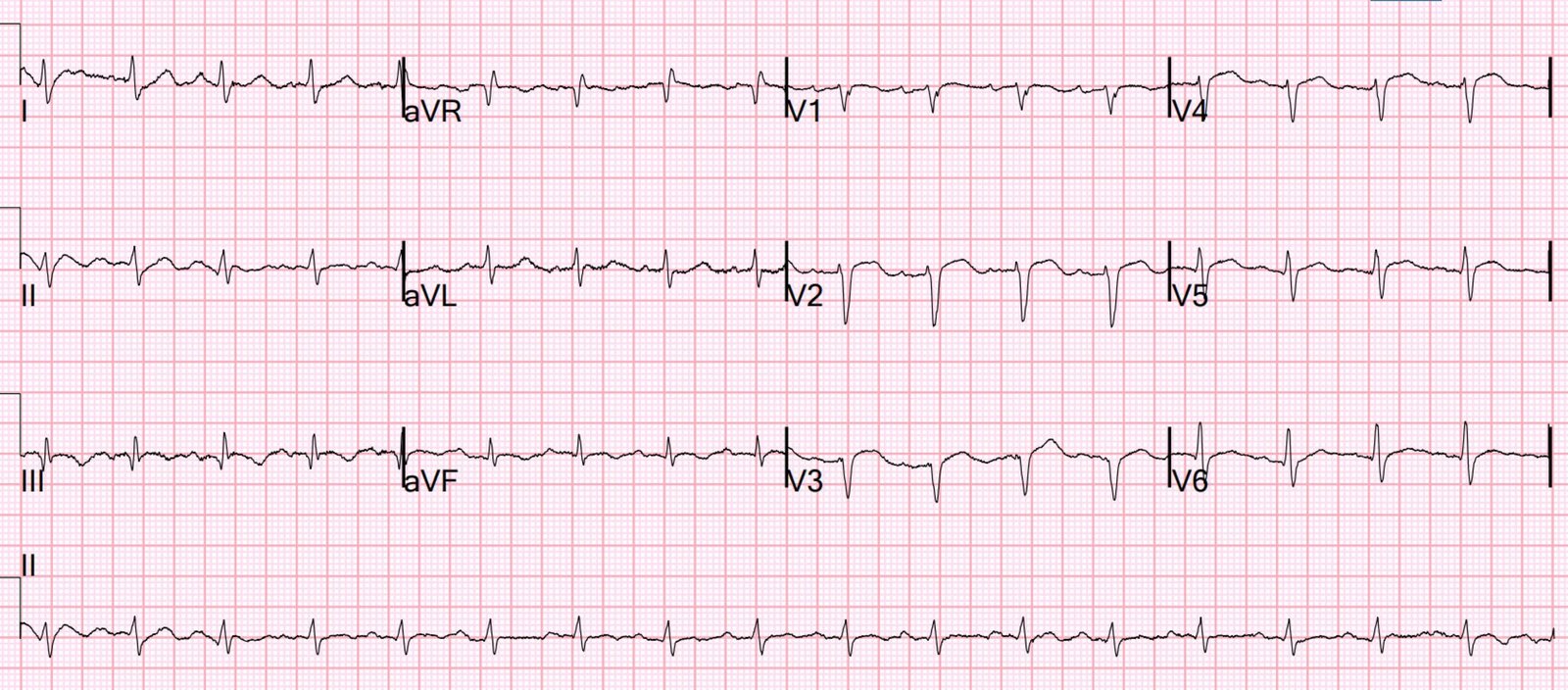 "Sepsis" with an ECG and Echo surprise - Dr. Smith’s ECG Blog