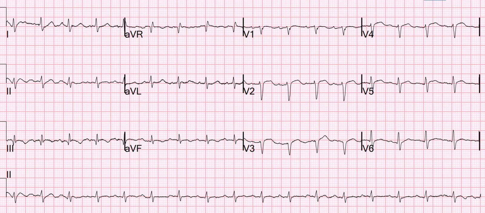 "Sepsis" with an ECG and Echo surprise - Dr. Smith’s ECG Blog