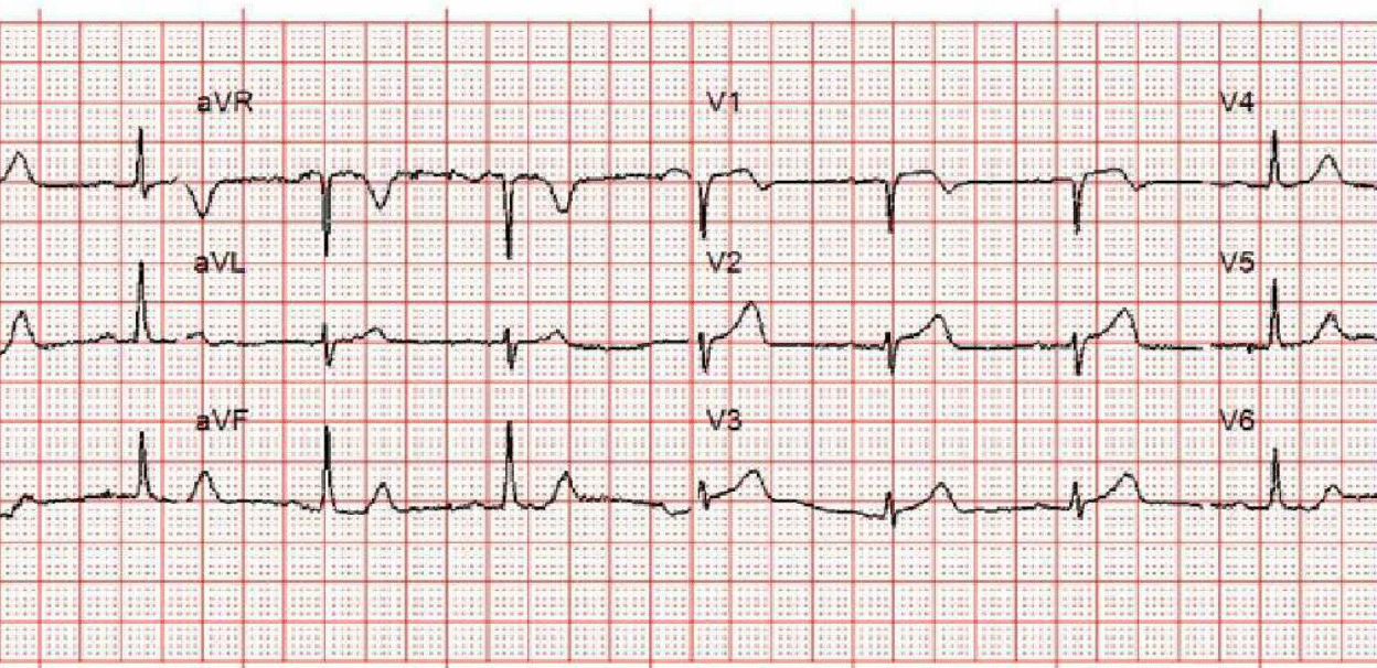 A woman in her 60s with chest pain and "No STEMI" - Dr. Smith’s ECG Blog