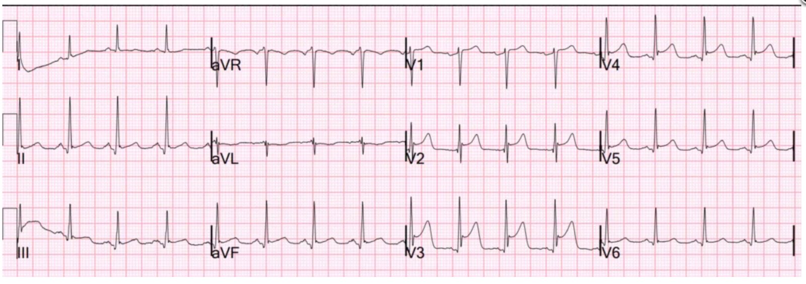 Acute chest pain in a 50-something: resolves, recurs, resolves: Does ...