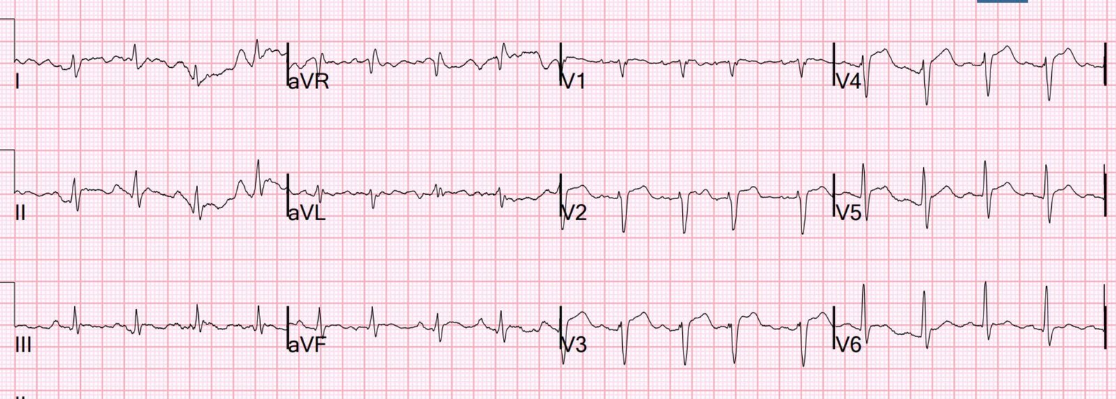 "Sepsis" with an ECG and Echo surprise - Dr. Smith’s ECG Blog