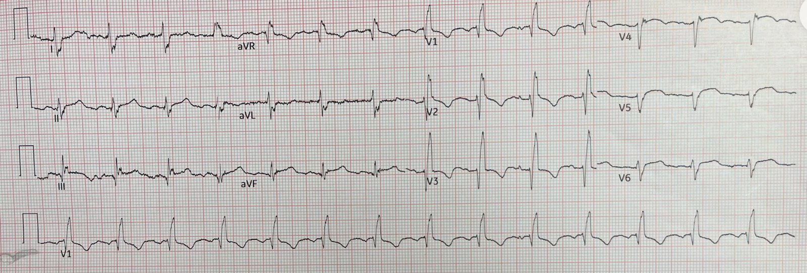 Elderly F w h/o MI has nausea and vertigo, with RBBB. And what is the ...