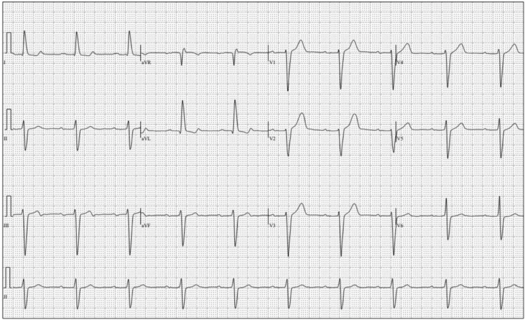 What does this ECG recorded 4 days prior (in clinic) tell us about the ...