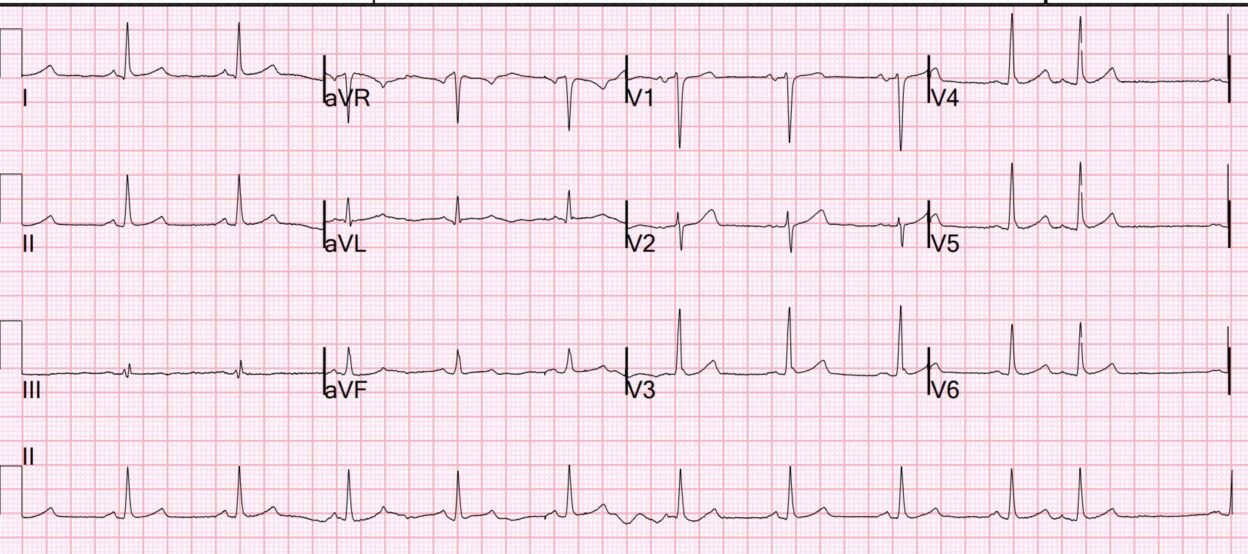 Narrow complex tachycardia; it recurs after adenosine. What should we ...