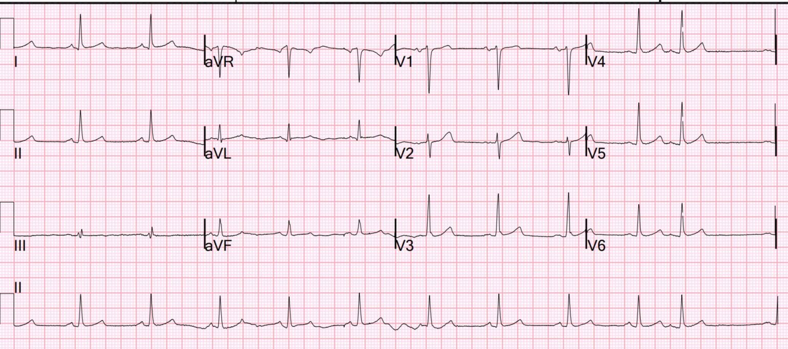 Narrow complex tachycardia; it recurs after adenosine. What should we ...