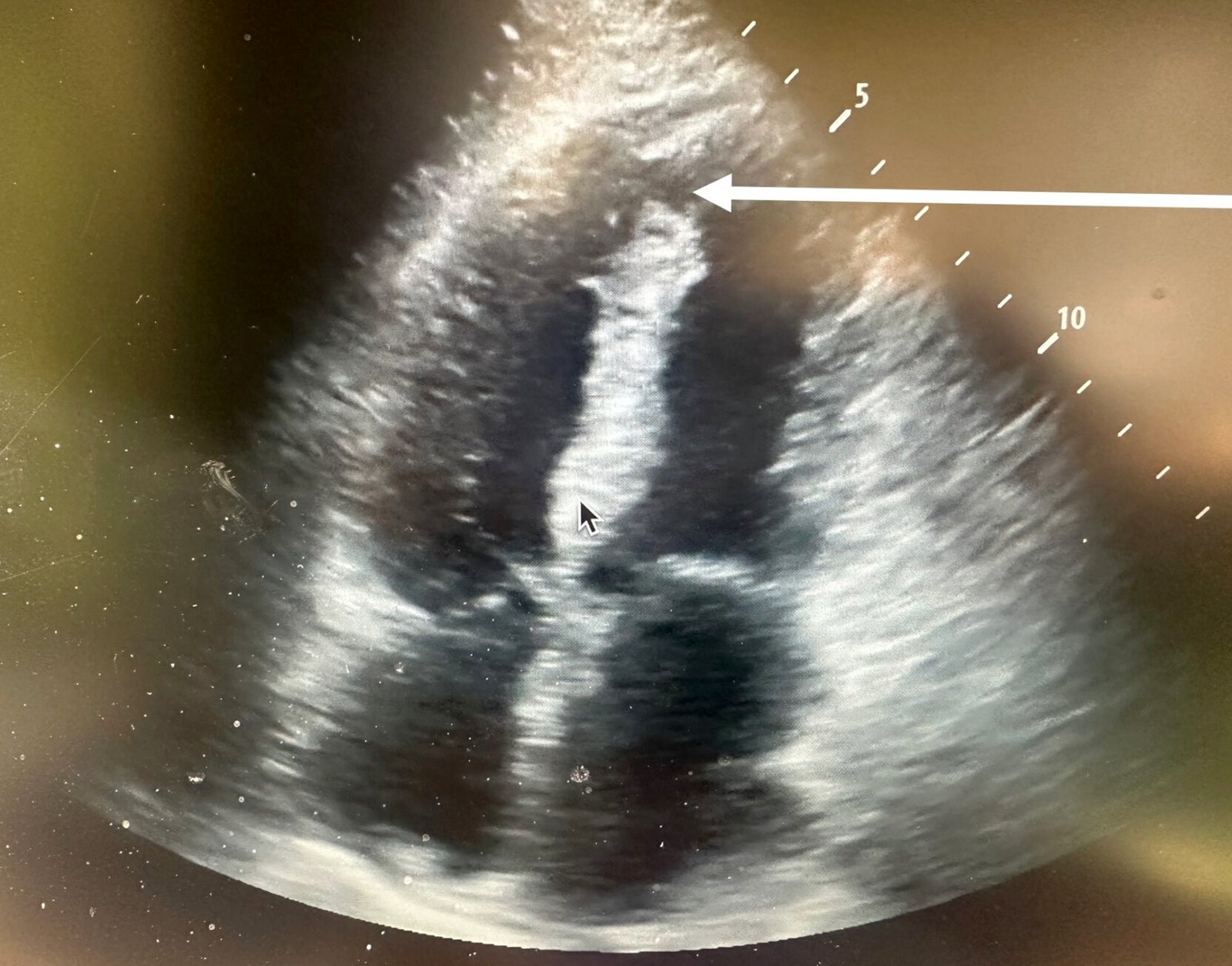 "Sepsis" with an ECG and Echo surprise - Dr. Smith’s ECG Blog