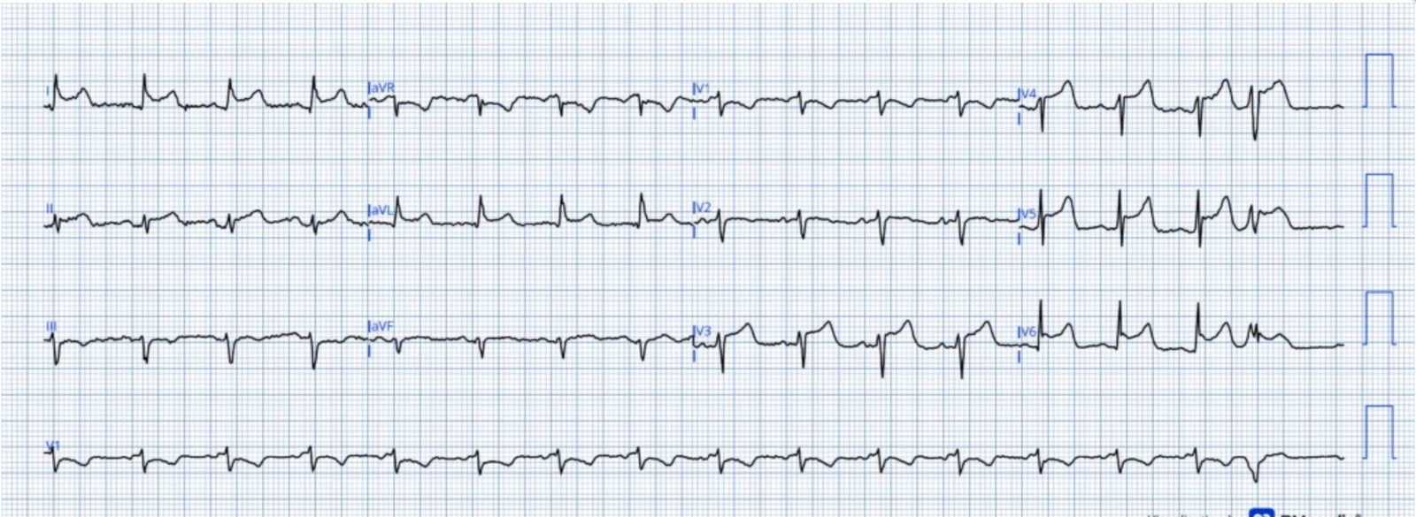 STEMI positive by conventional algorithm in a high risk post operative ...