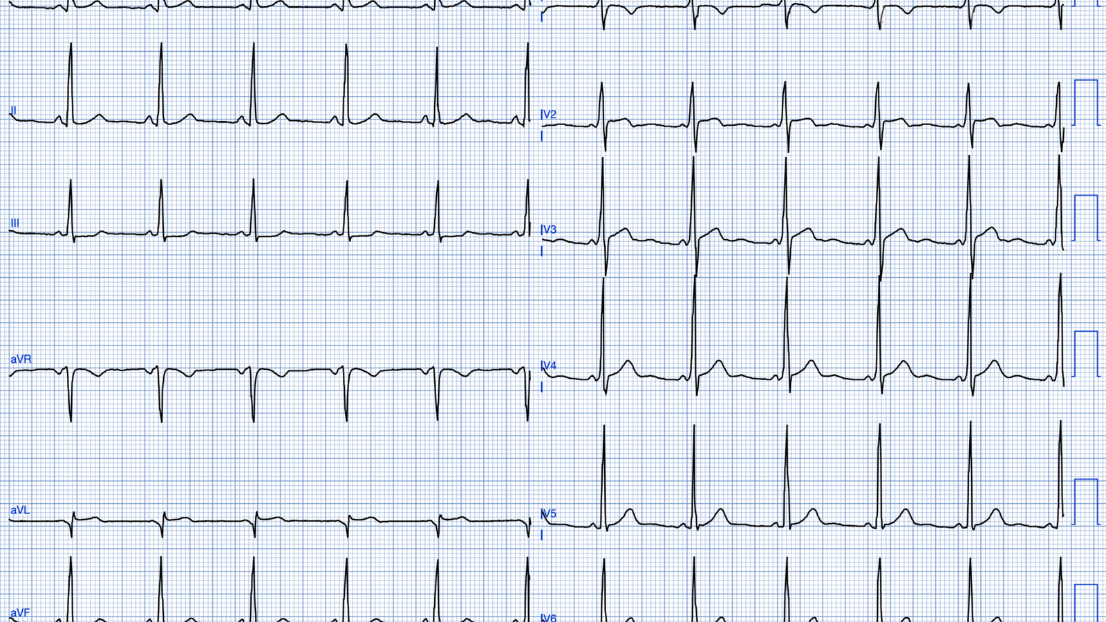 A Quiz on 10 ECGs - Dr. Smith’s ECG Blog