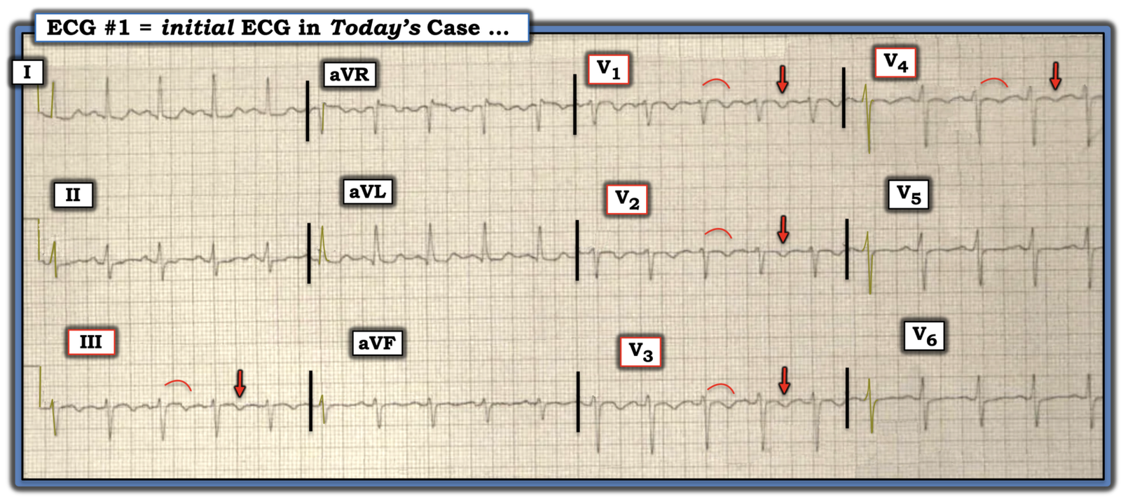 Is this ECG easy for you yet? - Dr. Smith’s ECG Blog