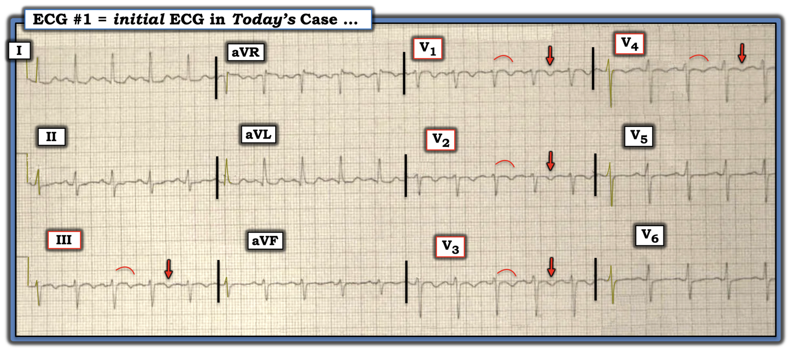 Is this ECG easy for you yet? - Dr. Smith’s ECG Blog