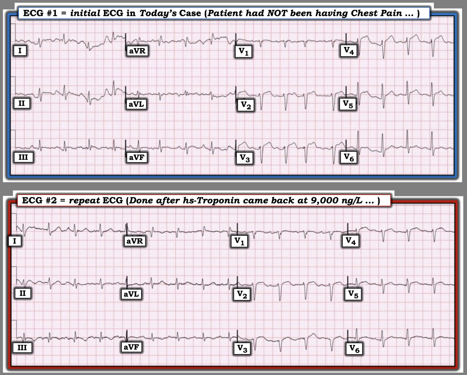 "Sepsis" with an ECG and Echo surprise - Dr. Smith’s ECG Blog