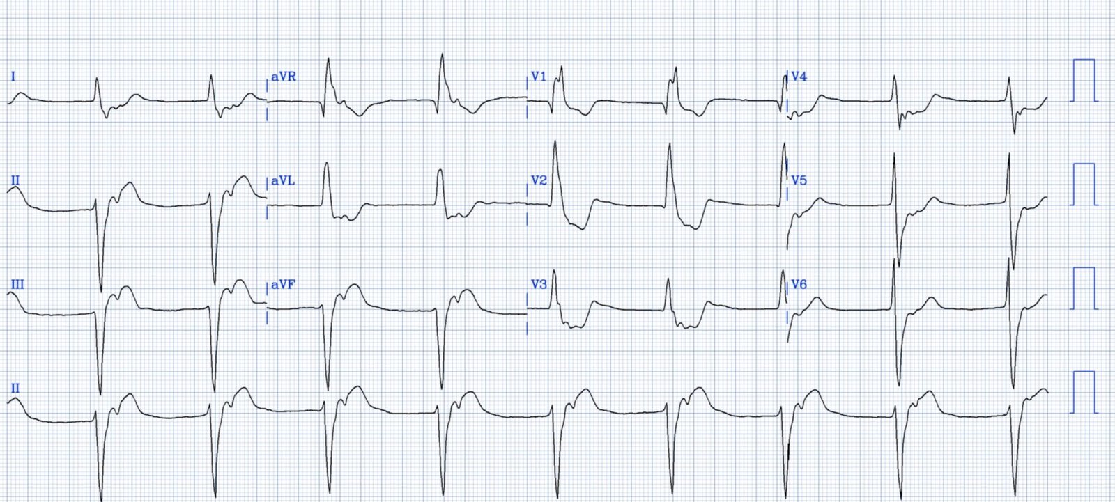 How do you interpret this ECG without the clinical context (which I don ...