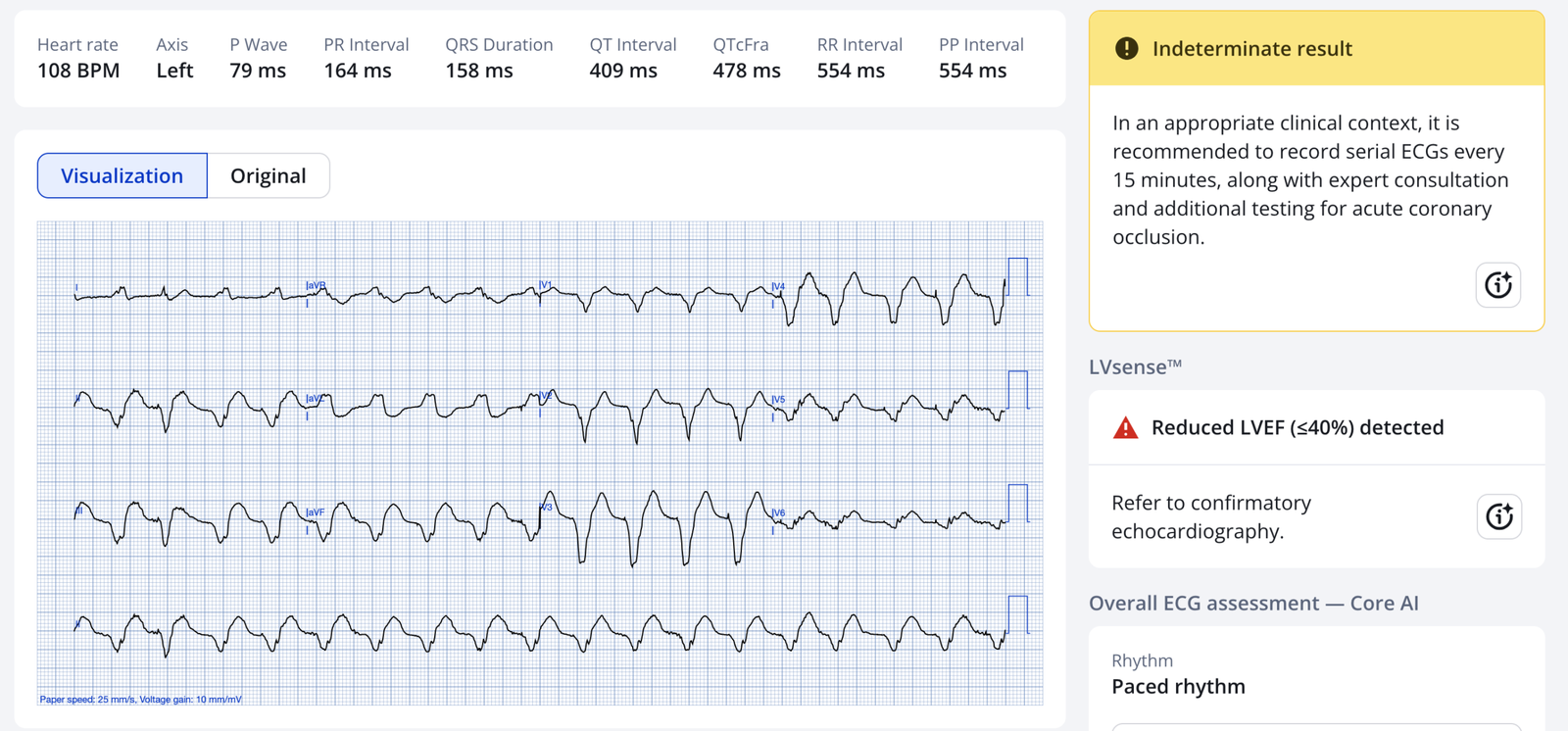 Acute Cardiogenic Shock in a patient with ventricular paced rhythm ...