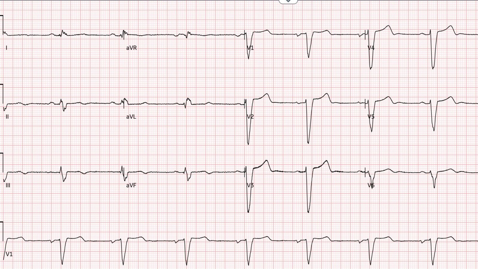 Dofetilde (and ibutilide -Class III antidysrhythmics). What is the risk ...