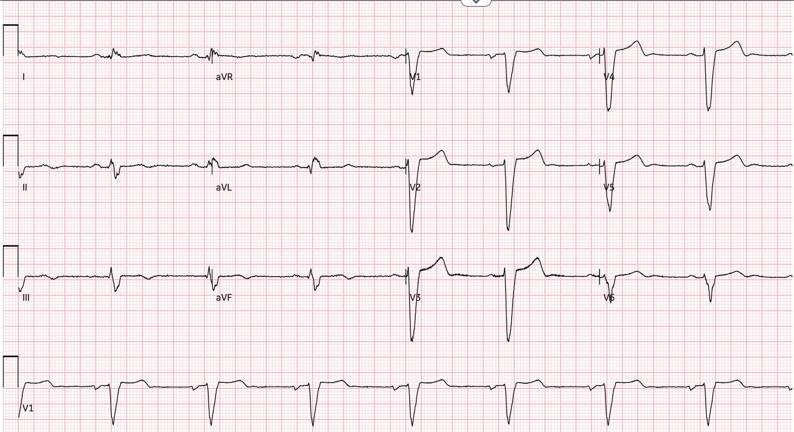 Dofetilde (and ibutilide -Class III antidysrhythmics). What is the risk ...