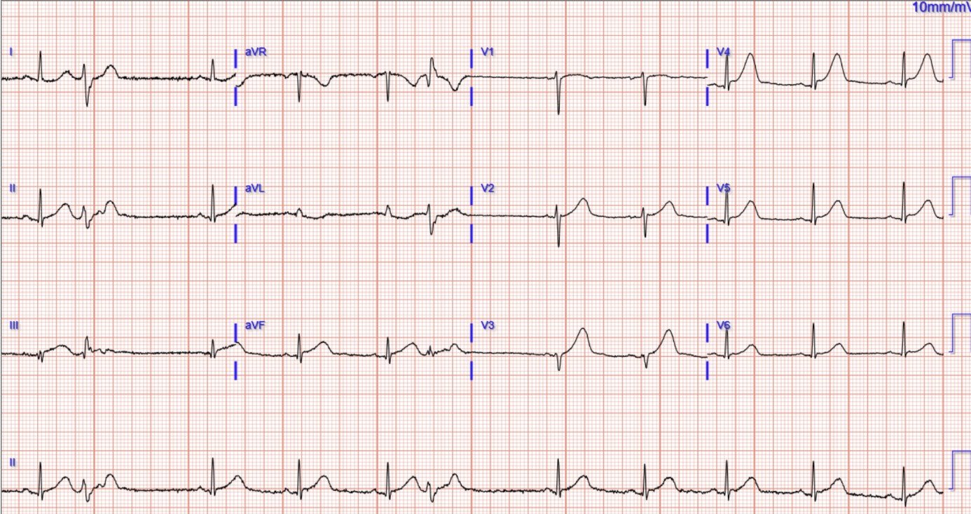 Will this patient get care of the past or care of the future? (NSTEMI ...