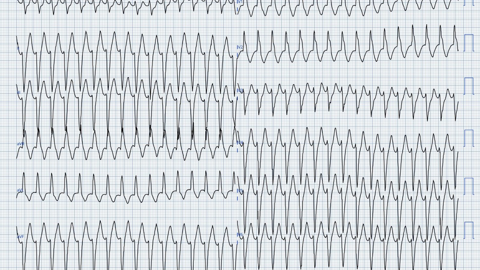"Sepsis" with an ECG and Echo surprise - Dr. Smith’s ECG Blog