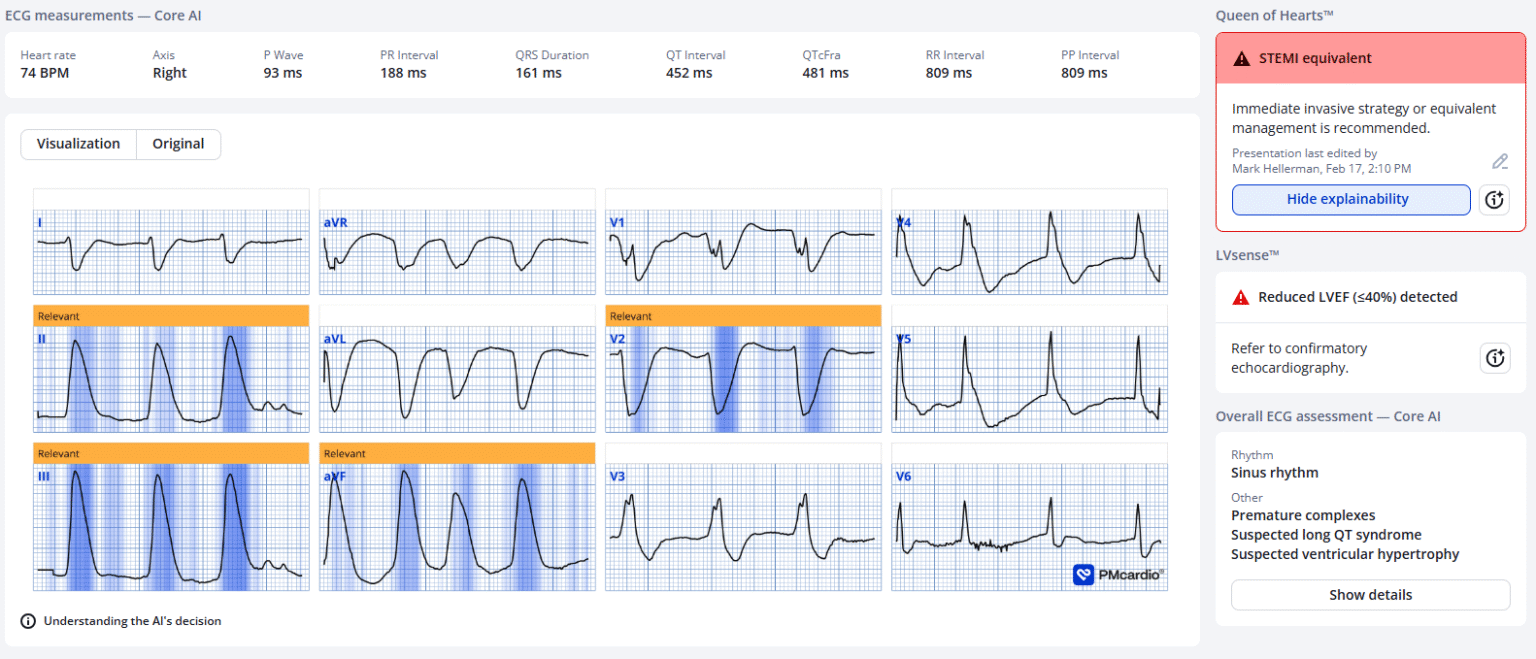 Is this a wide complex rhythm? (And what is the etoliogy, after you ...
