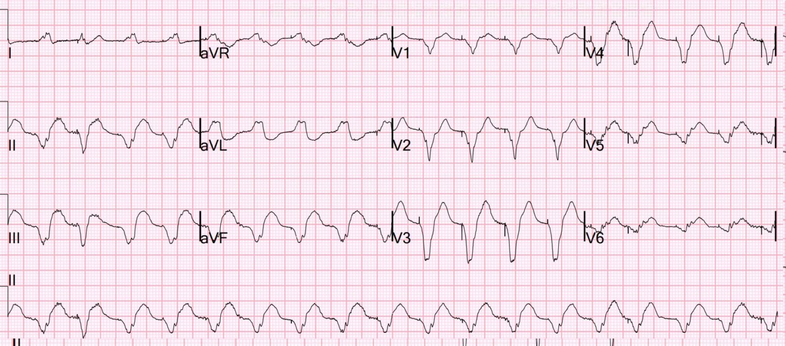 Acute Cardiogenic Shock in a patient with ventricular paced rhythm ...