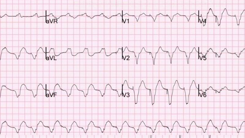 Acute Cardiogenic Shock in a patient with ventricular paced rhythm ...
