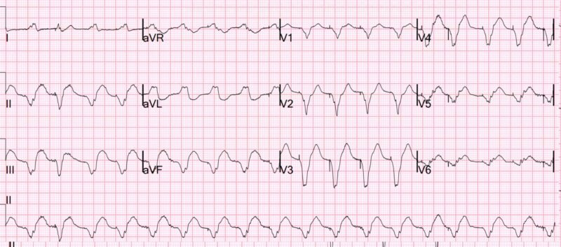 Acute Cardiogenic Shock in a patient with ventricular paced rhythm ...