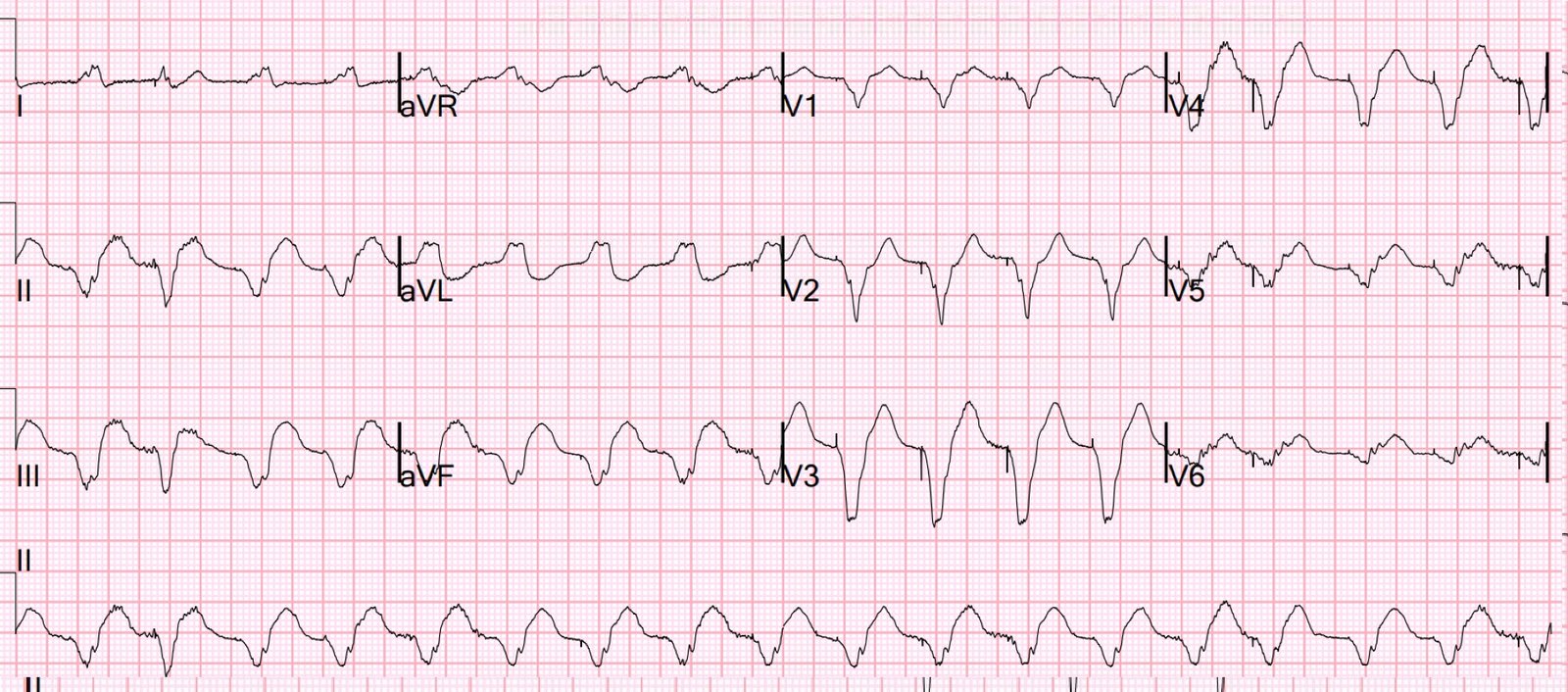 Acute Cardiogenic Shock in a patient with ventricular paced rhythm ...