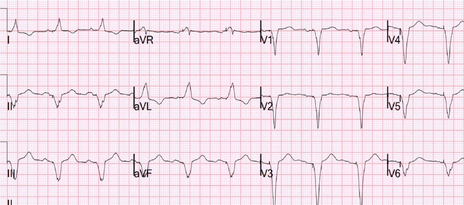 Acute Cardiogenic Shock in a patient with ventricular paced rhythm ...
