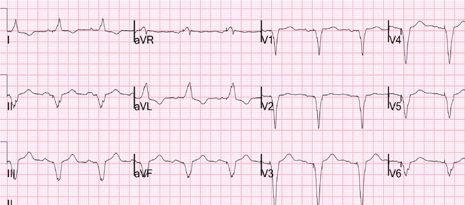 Acute Cardiogenic Shock in a patient with ventricular paced rhythm ...