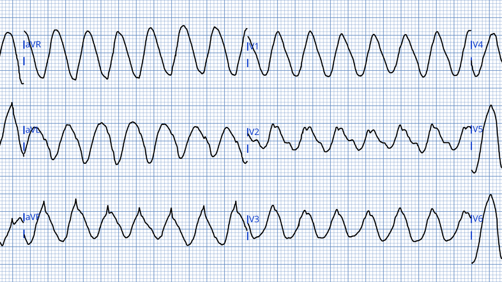 Why is there ST Elevation in lead V2? Think Lead Placement. - Dr. Smith ...