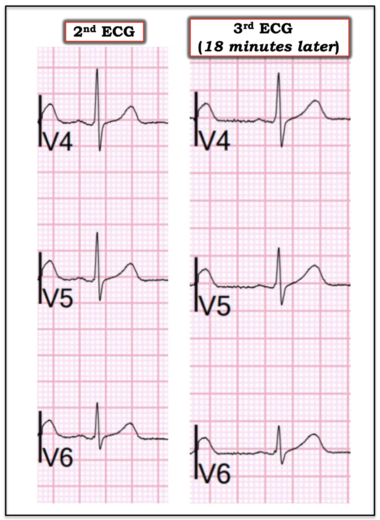 30-something woman with a HEART score of zero, EDACS of 2, computer ...
