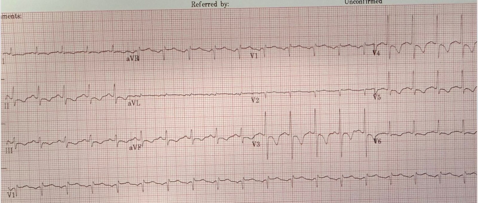 Intense burning chest pain in a 40-something woman - Dr. Smith’s ECG Blog