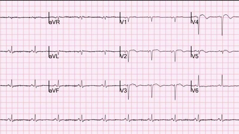 Online QTc Calculator for normal and wide QRS (LBBB, RBBB, etc.) - Dr ...