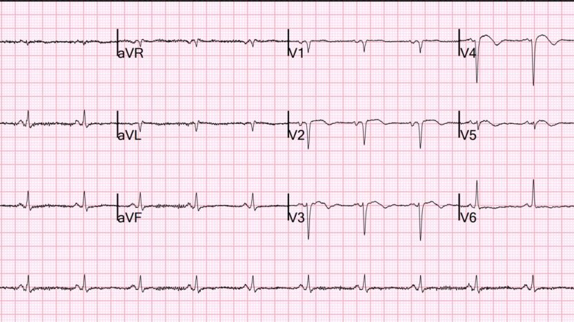 A 35-year old woman with this post-ROSC ECG. What does "shark fin ...