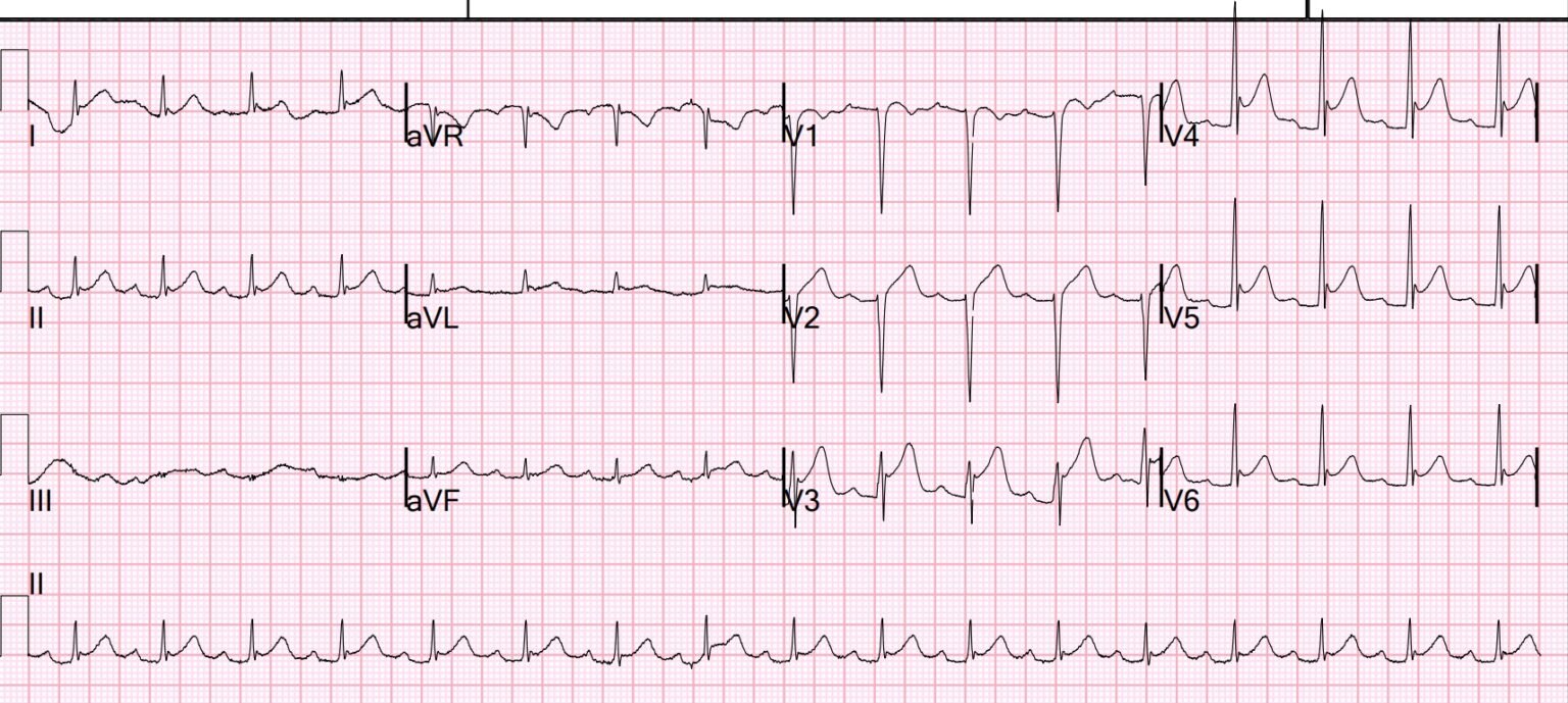Acute chest pain and ST Elevation. Take a moment to look through the ...