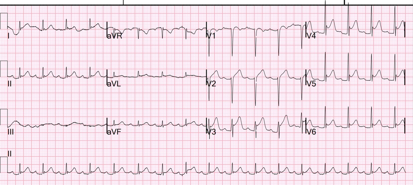Acute chest pain and ST Elevation. Take a moment to look through the ...